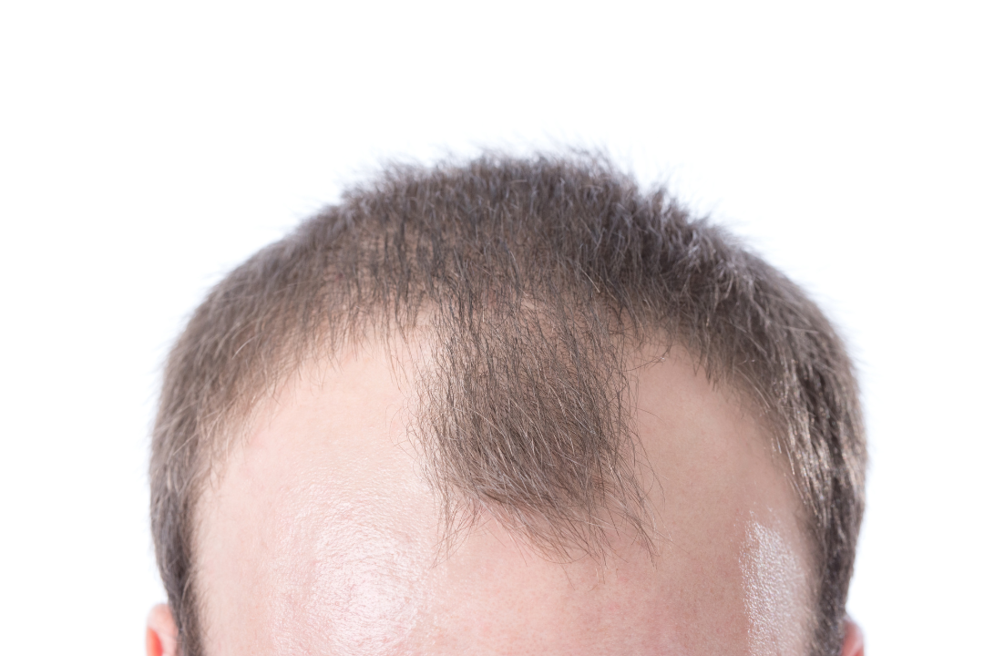 Why Do I Have a Receding Hairline? - Skin&Beauty